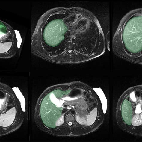 Automatic Liver Segmentation Example Using A 3 D U Net Model On A