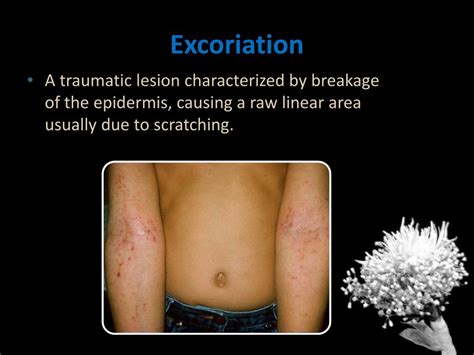 What Is Perianal Skin Excoriation Egqztf