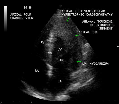 Apical Hypertrophic Cardiomyopathy Of Left Ventricle Sciencefrontier