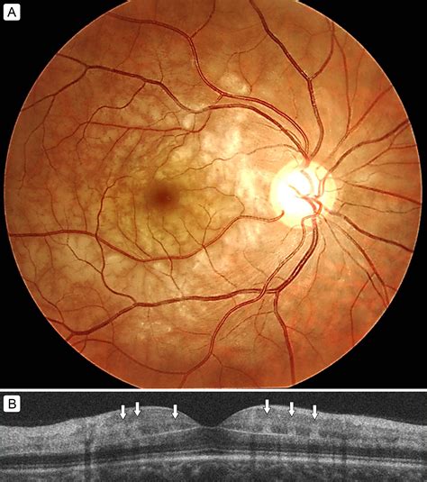 Digital Journal Of Ophthalmology