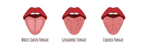 Yeast Infection Tongue