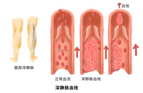 深静脉血栓 医学插画