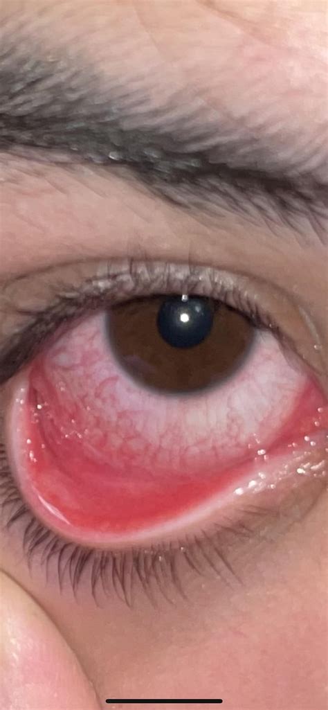 Why Is My Right Eye So Much More Red Than My Left Reyedoctors