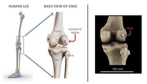 Fabella Syndrome Wikism Sports Medicine Wiki