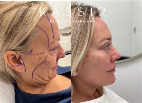 Discover The Mini Facelift Cost Before And After And More — Kassir