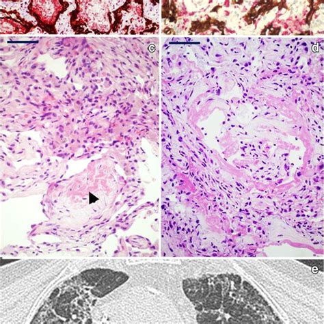 Histology And Radiology Of Mid Phase Dad Pattern A Ck7 And Mallory