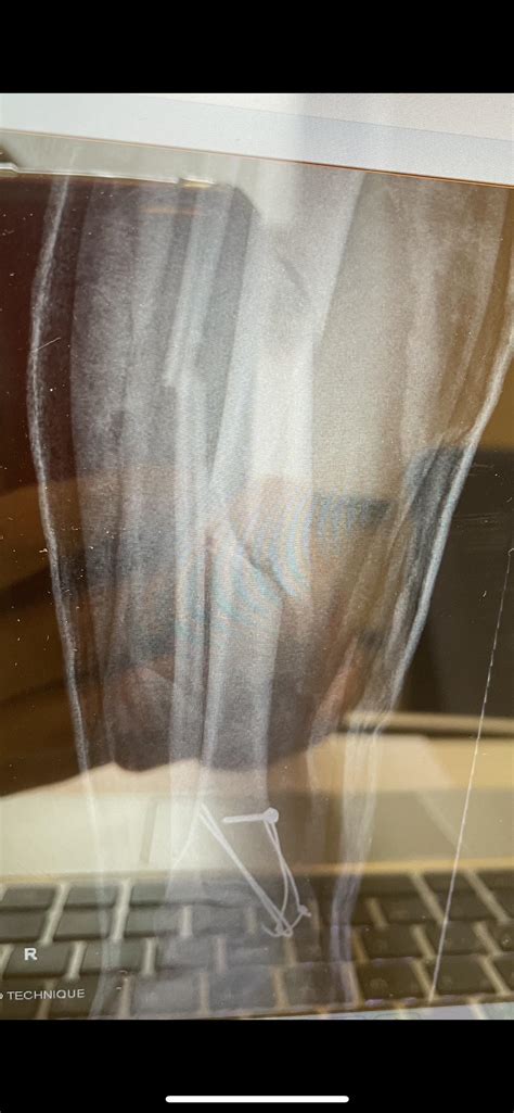 My Broken Tibia And Fibula Rxrayporn