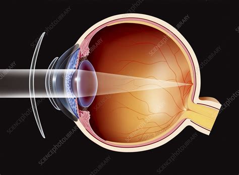 Refractive Surgery Treatments Illustration Stock Image C060 2212 Science Photo Library