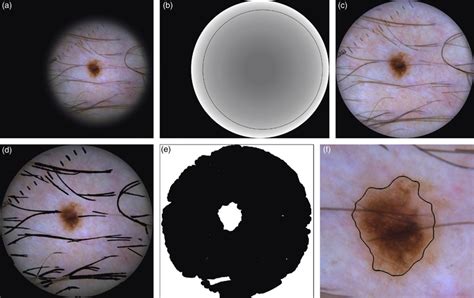 Segmentation Steps A Input Image B The Red Layer Of The General Download Scientific
