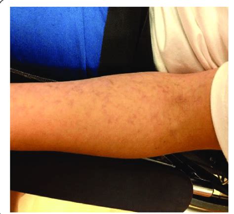 Livedo Reticularis Like Skin Manifestation Occurring On Both Arms But Download Scientific