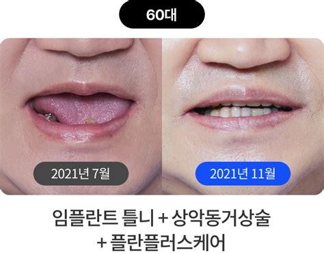 나에게 딱 맞는 맞춤 임플란트 플랜 플란치과