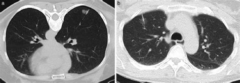 Computed Tomography Guided Hook Wire Localization By Two Protocols A