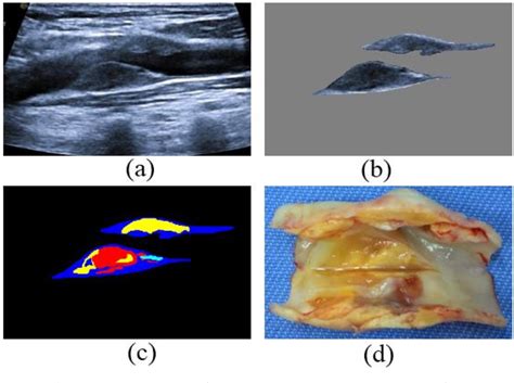 Figure 1 From Hru Net A Transfer Learning Method For Carotid Artery