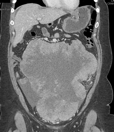 Gist Tumor Off Duodenum Extends Into The Pelvis Small Bowel Radiology
