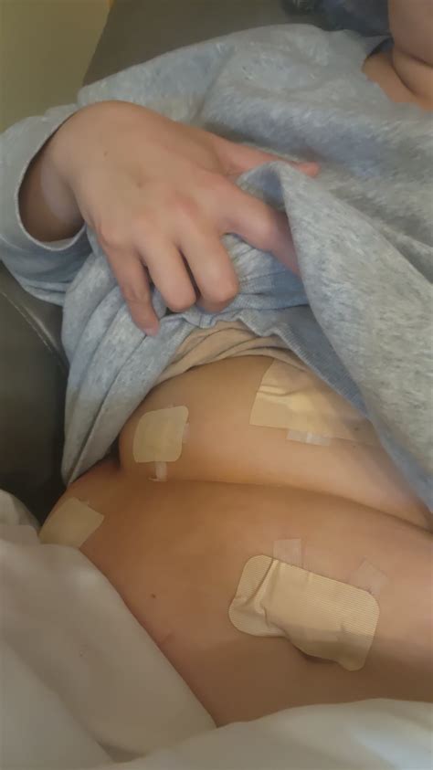 Gallbladder Attacks After Surgery Rgallbladders