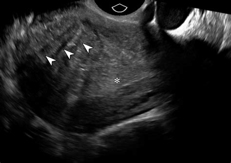 Adenomyosis A Sonographic Diagnosisradiographics