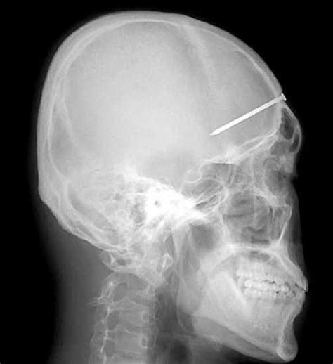 11 Unexpected Things Found Inside The Human Body During X Rays