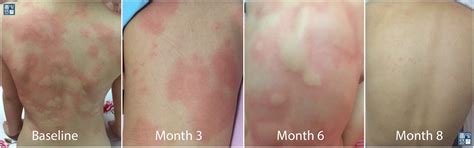 Proven Tcm Hives Treatment Singapore Tangs Clinical