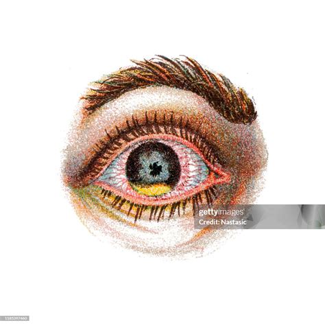 Eye Diseases Ocular Inflammation Hypopyon Is A Medical Condition