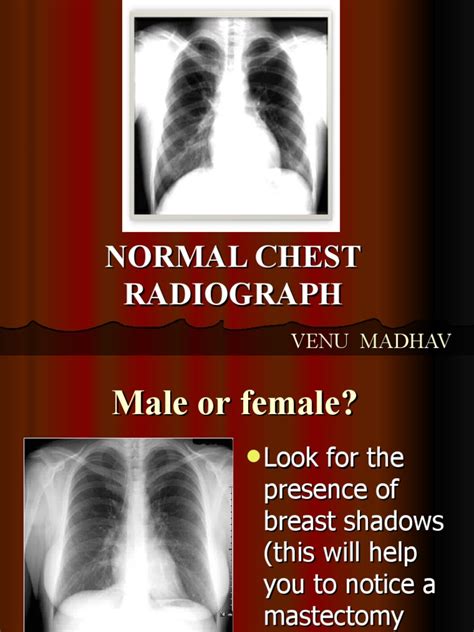 Normal Chest Radiograph Pdf Radiography Lung