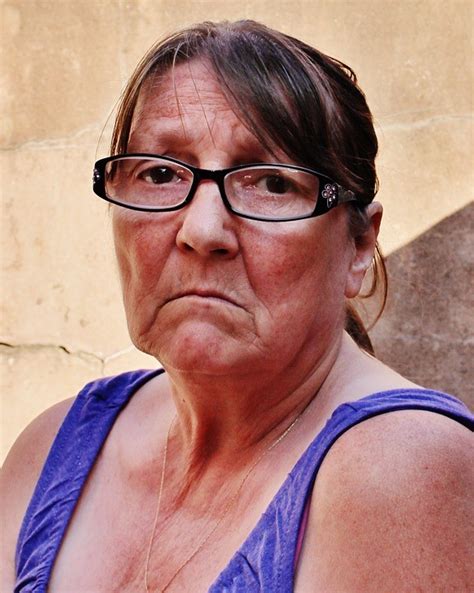 Seborea Příznaky Léčba A Užitečné Tipy Z Domácí Lékárničky