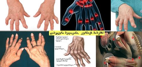 Rana Ge ადამიანთა უმრავლესობას ასაკის მატებასთან ერთად სახსრების ტკივილი აწუხებს სიტყვა