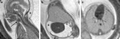 Pyothorax Without Fistula
