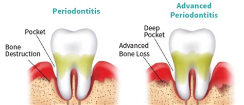 Gum Disease Heritage Dental Specialists