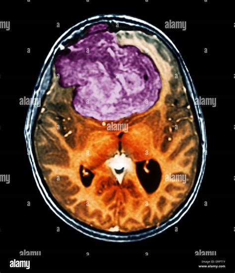 Understanding Brain Tumors