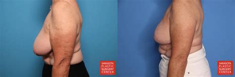 Breast Reduction Before And After Gallery Patient 24
