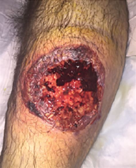 Pyoderma Gangrenosum Mistaken For Diabetic Ulcer Mdedge