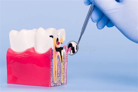 Dental Model Displaying Tooth Structure And Cavity Examined With A