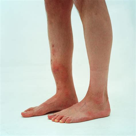 Broken Leg Photograph By Gary Parker Science Photo Library Fine Art