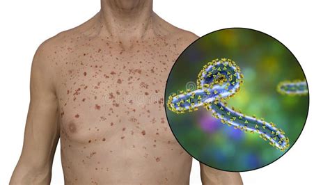 A Skin Rash On The Chest Of A Patient With Marburg Hemorrhagic Fever