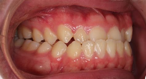 Underbite Overbite