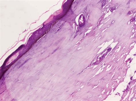 Section Of Skin Showing Homogenization And Basophilia Of Dermal Download Scientific Diagram