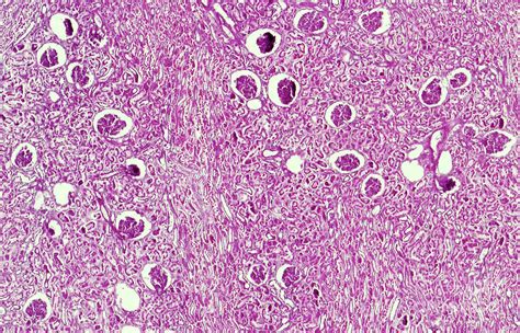 Diffuse Proliferative Glomerulonephritis 1 By Science Photo Library