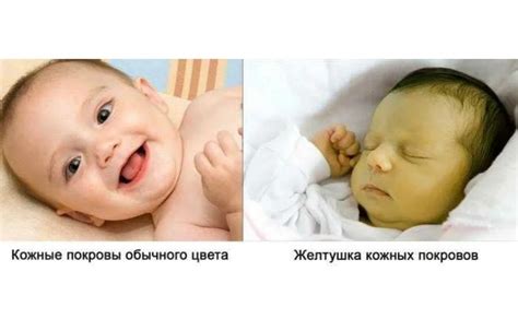 Желтуха новорожденных причины симптомы лечение