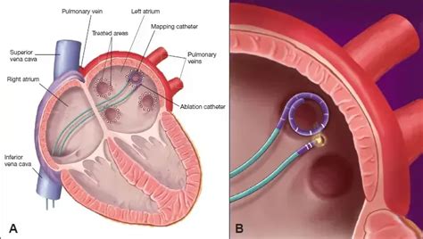 Heartplace Cardiovascular Disease Specialists And Cardiac Electrophysiologists Located In Allen