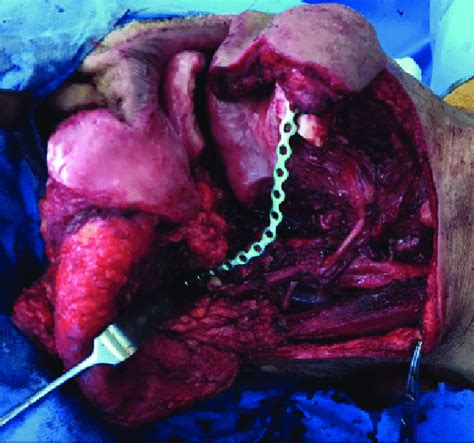 Reconstruction Of Segmental Mandibulectomy Aq9 Download Scientific