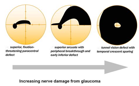 Open Angle Glaucoma Also Known As Chronic Glaucoma Healthtips By Teleme