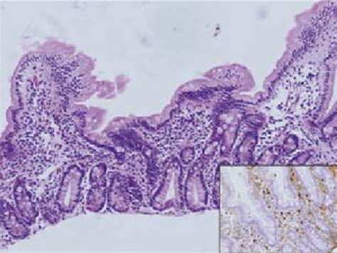 Endoscopic Biopsy Of Duodenum At William Trusty Blog