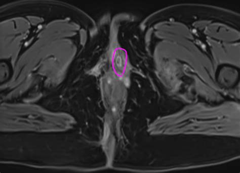 segmenting non vascular tubular structures in mri algorithms itk