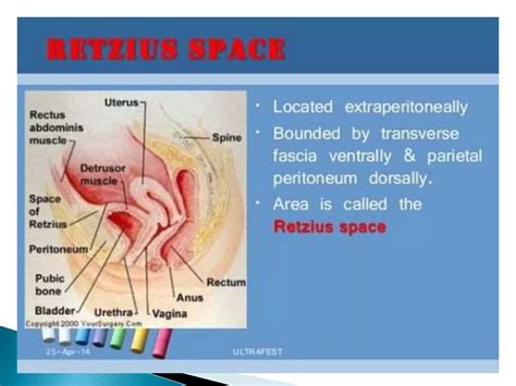 Laparoscopic Repair Of Inguinal Hernia Pptx