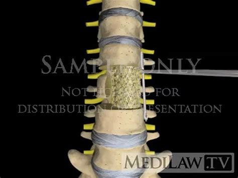 Lumbar Spine Surgery Vertebrectomy Corpectomy With Cage Plate