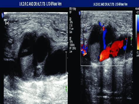A Gray Scale Image Showing Aneurysm Arising From Brachial Artery In