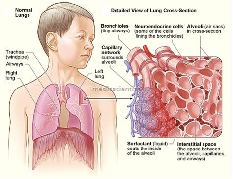 Interstitial Lung Diseases Clinical Features Examination Treatment MedicScientist Total