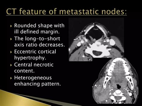 Imaging Of Cervical Lymph Nodes Pptx
