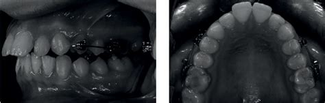 Figure 1 From Intermittent Orthodontic Force Should Always Be