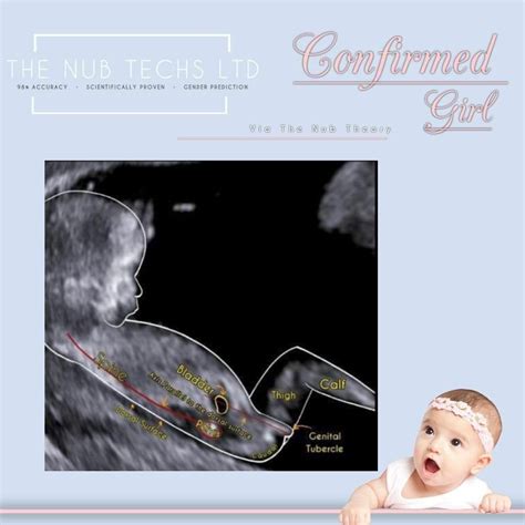 Ultrasound Nub Theory Uk The Nub Techs Artofit